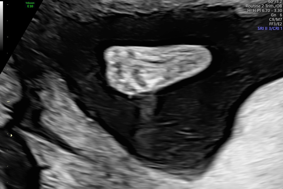 22 Wochen Ultraschall